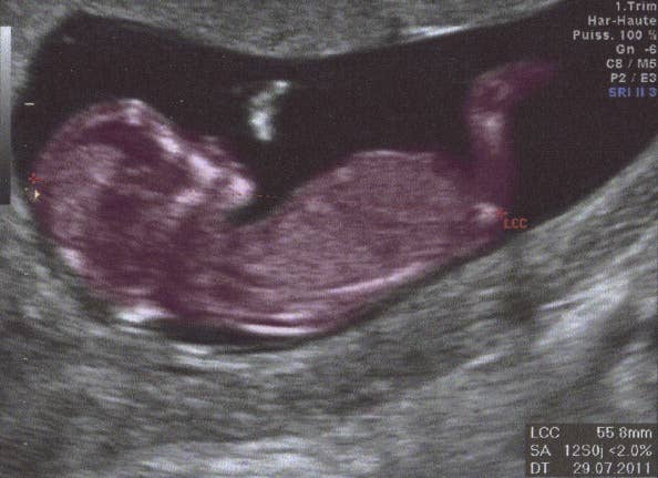 Dead fetus found inside boy who complained of stomach pains | Complex