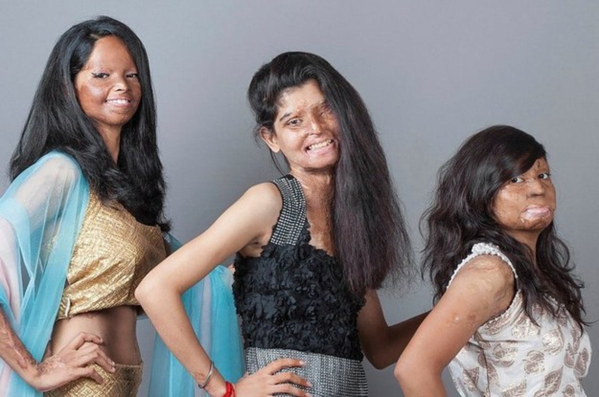 Meet The Acid-Attack Survivor Who Modelled In An Inspiring Photo Shoot ...