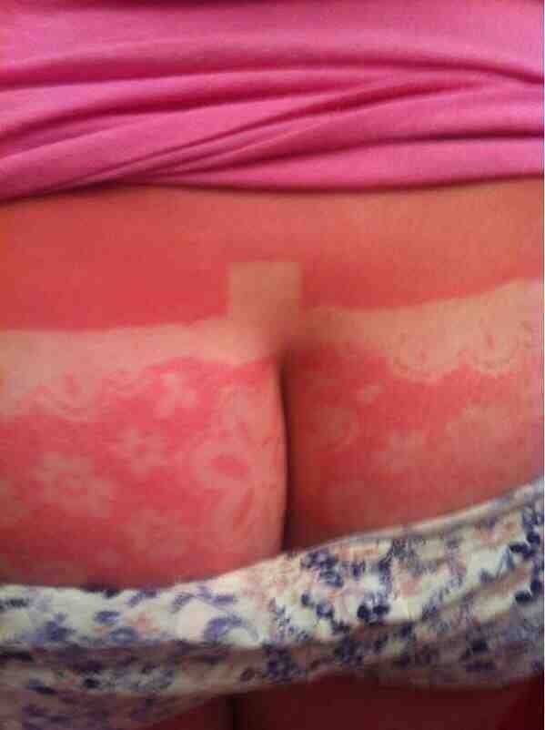 sunburn on bum cheeks