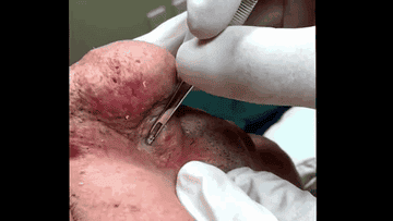 worst blackhead pops