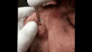 large blackheads