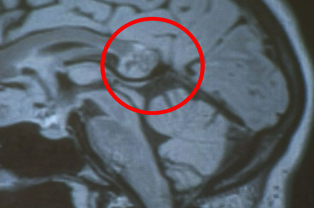 Doctors Removed An Embryonic Twin With Hair And Teeth From This Woman’s ...