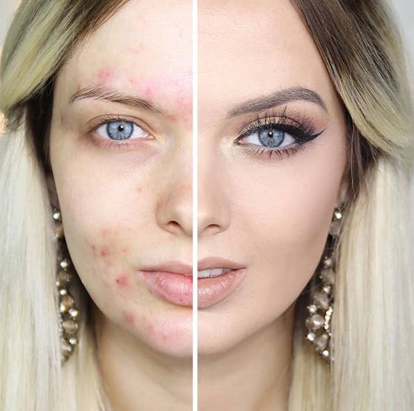 This Woman Completely Erases Her Acne With Makeup And It's Mind-Blowing