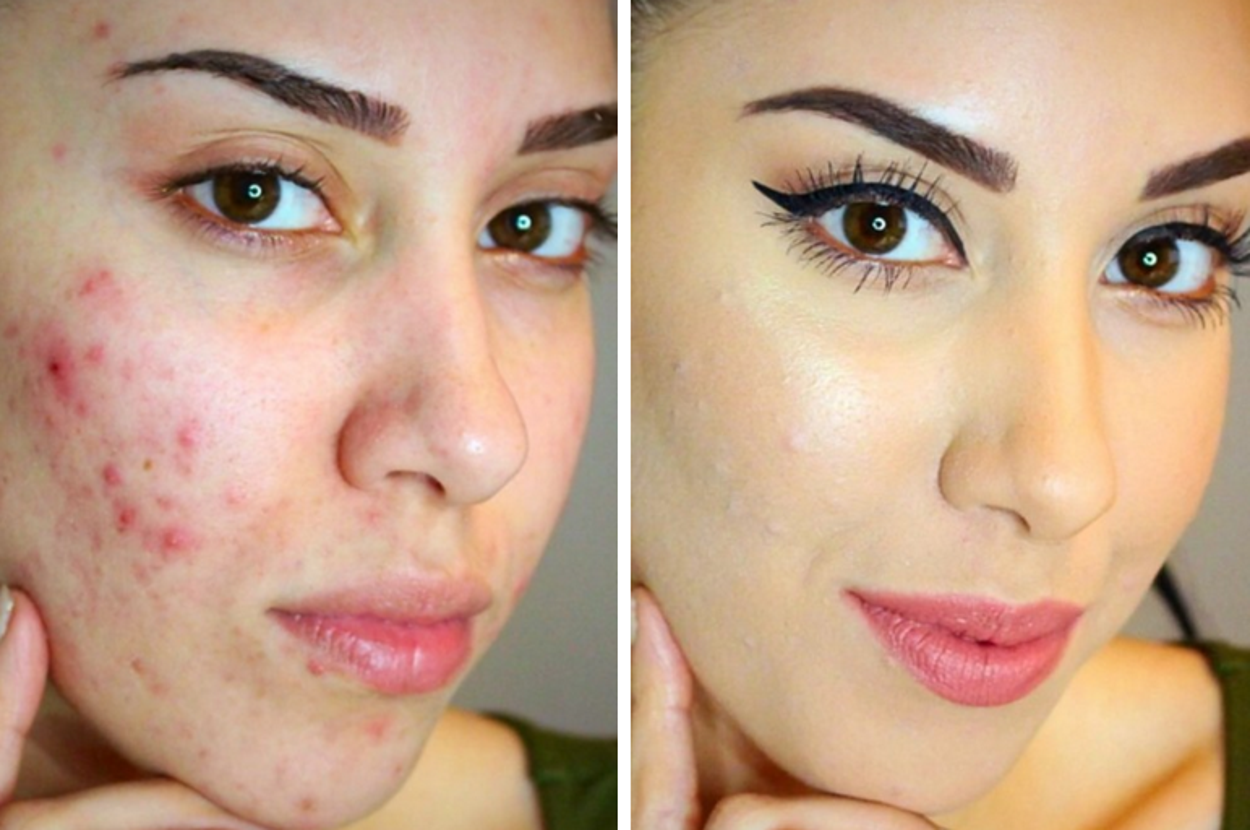 9 Women Share The Harsh Reality Of Living With Severe Acne