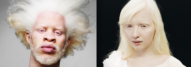 Most Beautiful Albino People