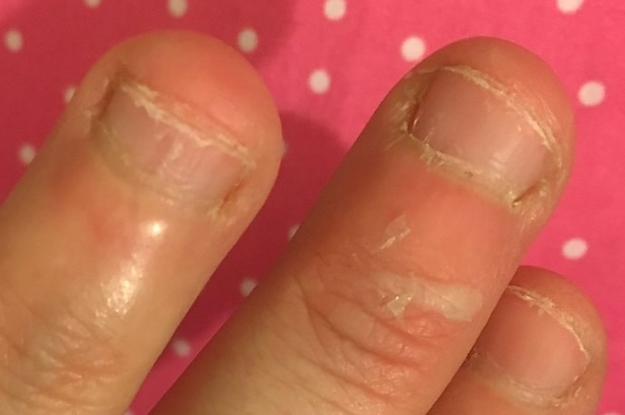 19 Powerful Images That You'll Only Recognize If You Bite Your Nails