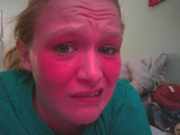 worst ever sunburn