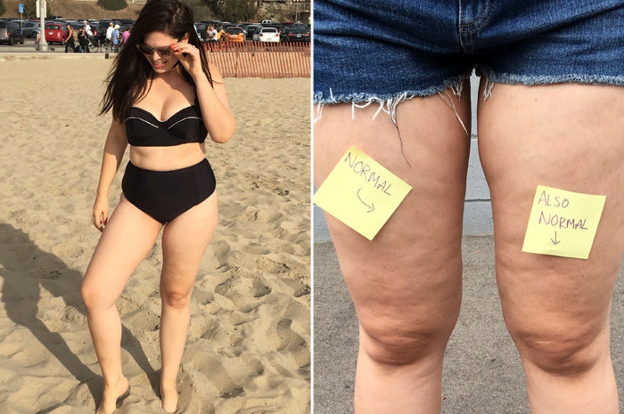 worst cellulite