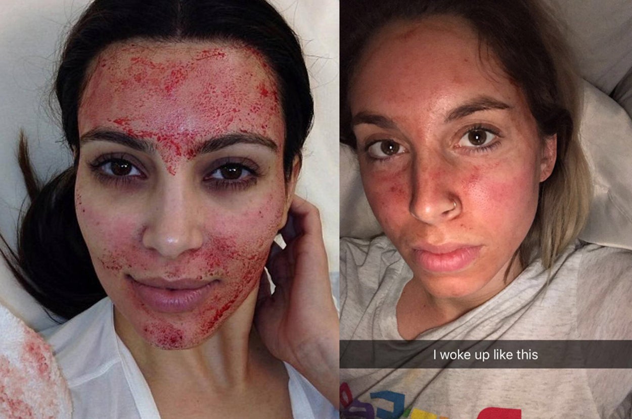 This Is What Getting A Vampire Facial Is Actually Like