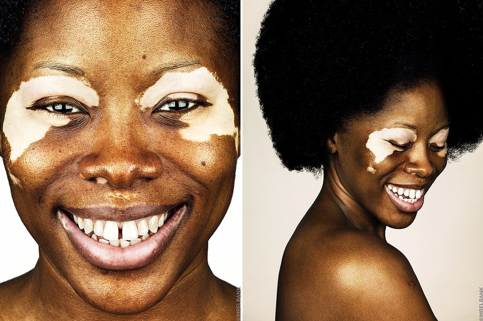 24 Pictures That Capture The Stunning Beauty Of Unique Skin