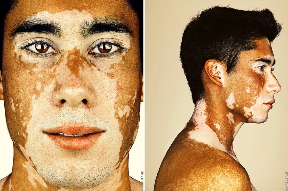24 Pictures That Capture The Stunning Beauty Of Unique Skin