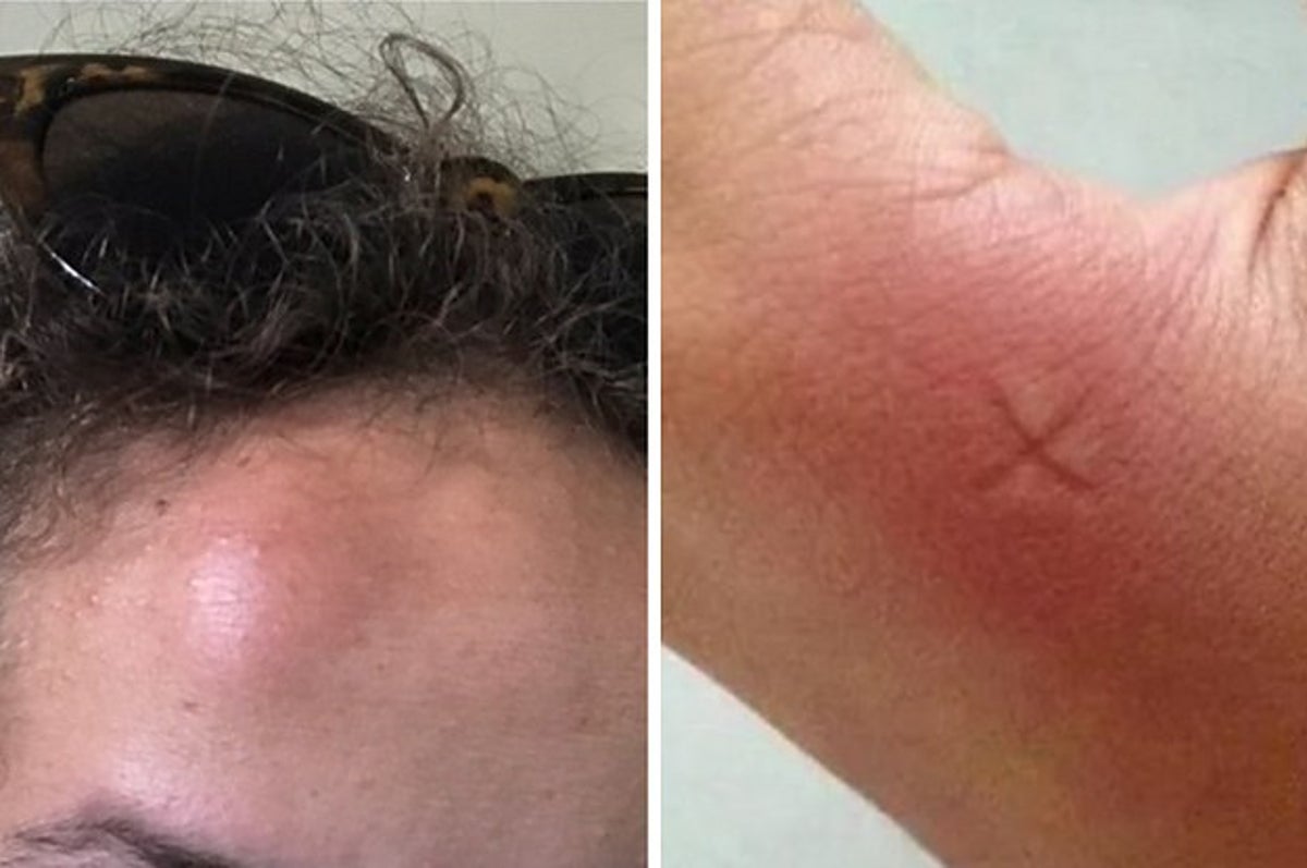 Biggest Bug Bite In The World