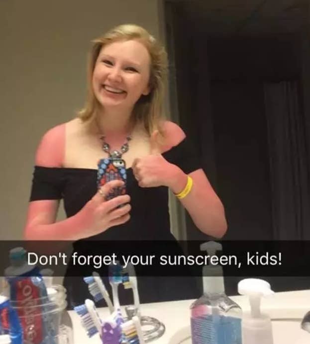 Show Us A Picture Of Your Worst Sunburn Ever