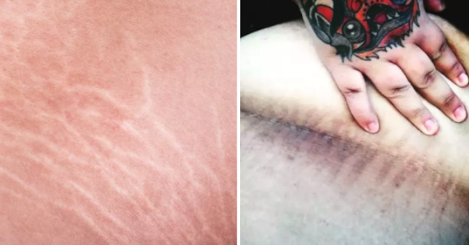 tiger claw stretch marks
