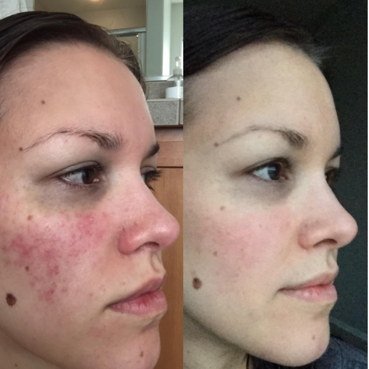 21 Of The Best Acne Control Products You Can Get On Amazon