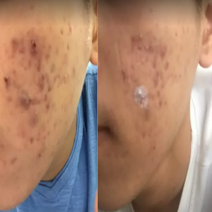 21 Of The Best Acne Control Products You Can Get On Amazon