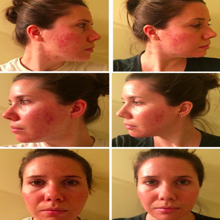 21 Of The Best Acne Control Products You Can Get On Amazon