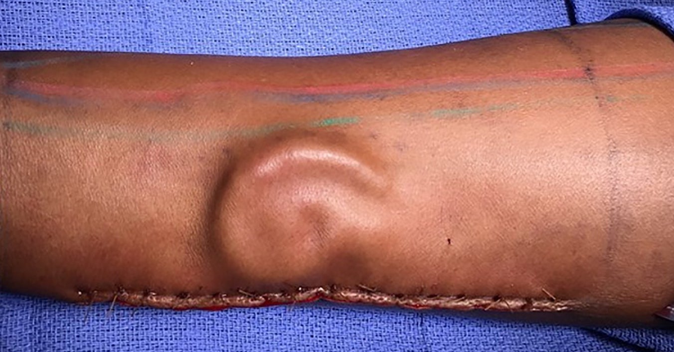 Army Doctors Grew A New Ear Transplant Inside A Soldier's Forearm