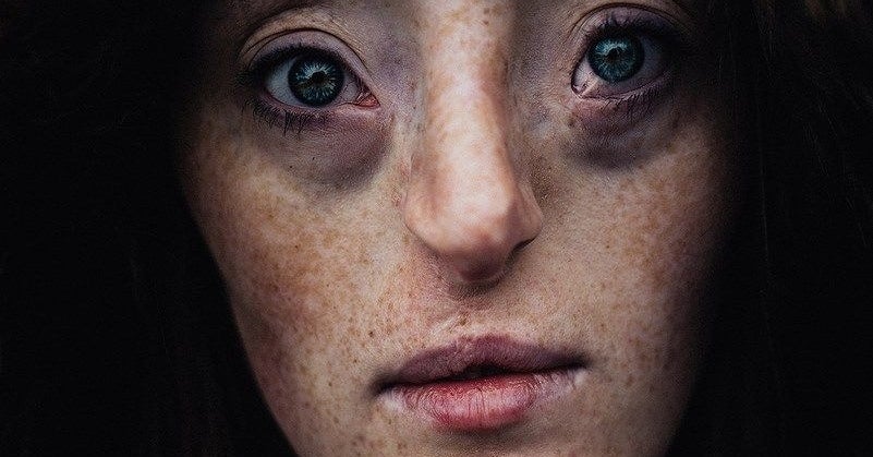 A Model Born With A Facial Cleft Is Shattering Beauty Standards And It ...