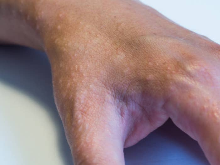 Yes Sun Allergies Are Real And Here s How To Know If You Have One Yes Sun Allergies Are Real And Here s How To Know If You Have One