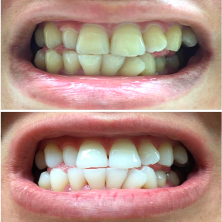 24 Of The Best Teeth Whiteners You Can Get On Amazon