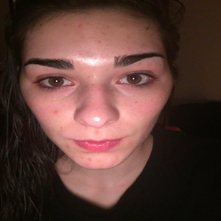 These 26 Things Fix Breakouts And We Have The Proof