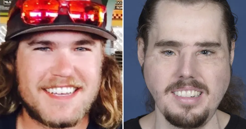 Joshua Face Transplant