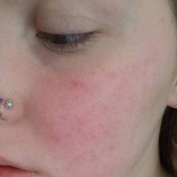 23 Ways To Get Clear Skin And Keep It That Way