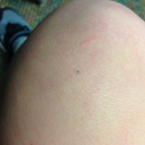 Stabbed By A Pencil And Still Have A Mark? Answer These Questions