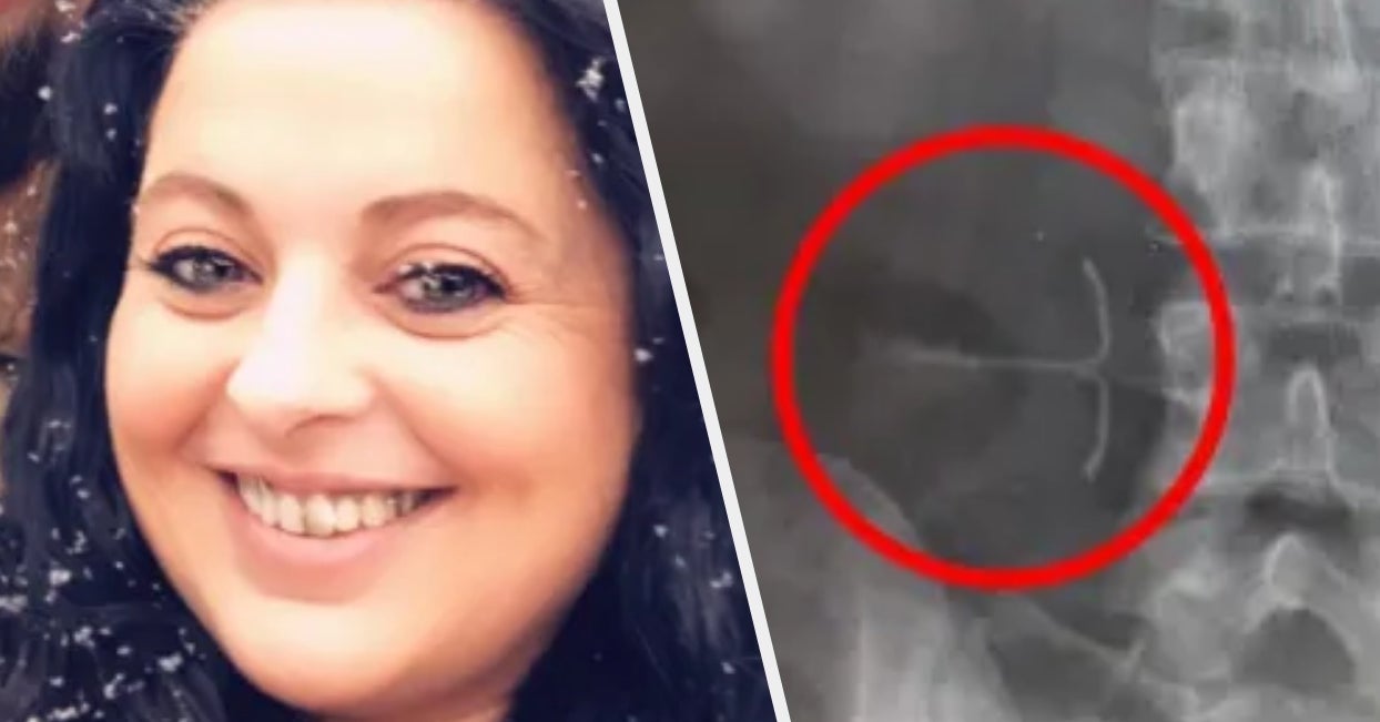 This Woman Had An IUD Floating Around Her Abdomen For 11 Years