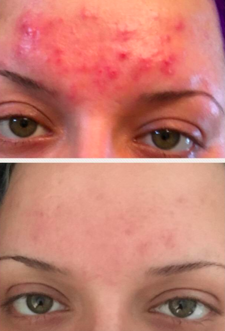 19 Acne Control Products On Amazon That Actually Work