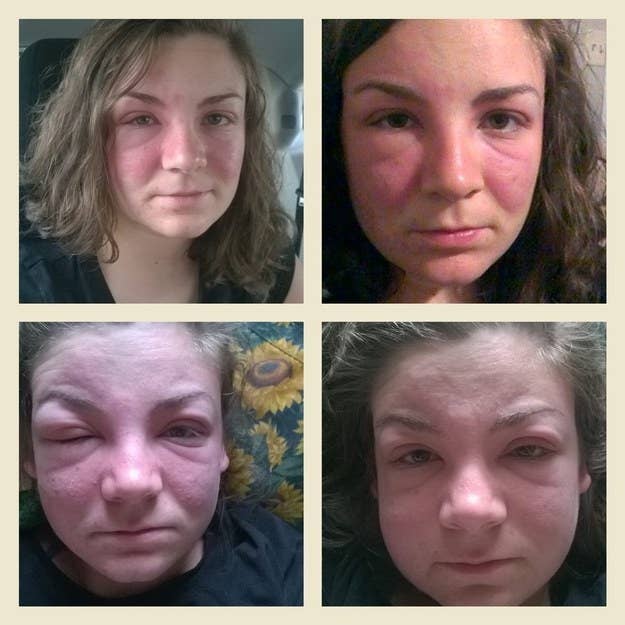 anaphylaxis swelling face