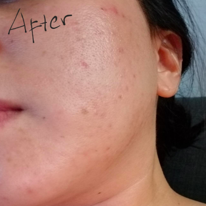 27 Things That'll Get Rid Of Pimples As Fast As Possible