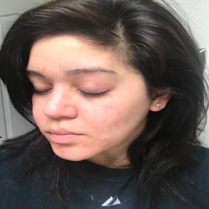 27 Things That'll Get Rid Of Pimples As Fast As Possible