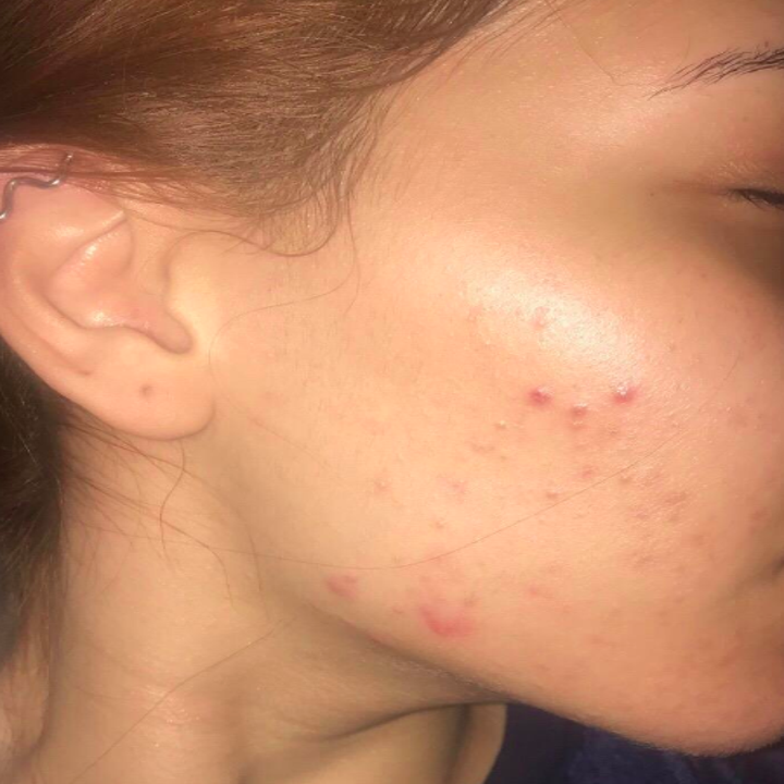 27 Things That'll Get Rid Of Pimples As Fast As Possible