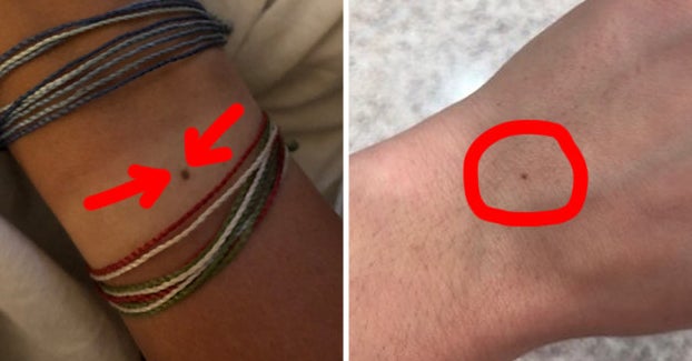 If You Have A Freckle In The Middle Of Your Wrist, You Are Not Alone