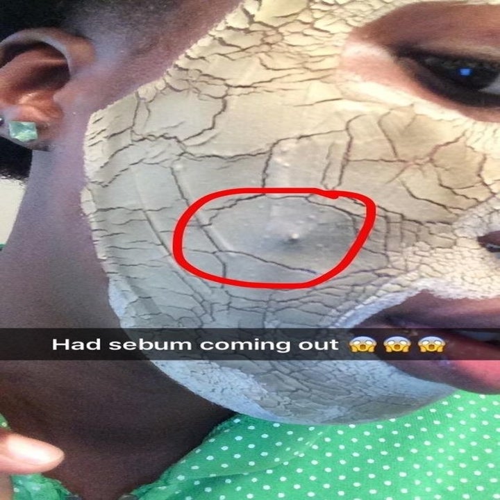 31 Ways To Help Get Rid Of A Pimple In A Hurry