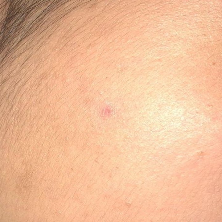 31 Ways To Help Get Rid Of A Pimple In A Hurry