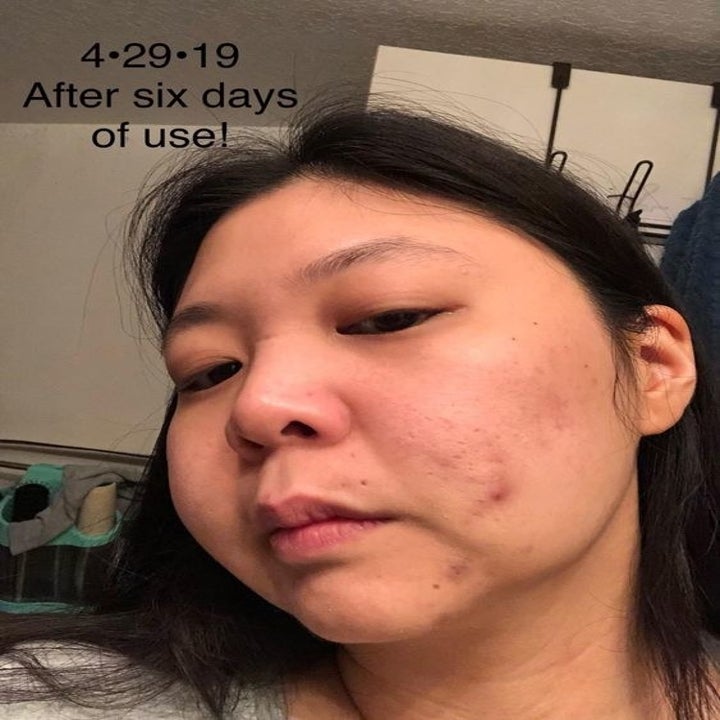 31 Ways To Help Get Rid Of A Pimple In A Hurry