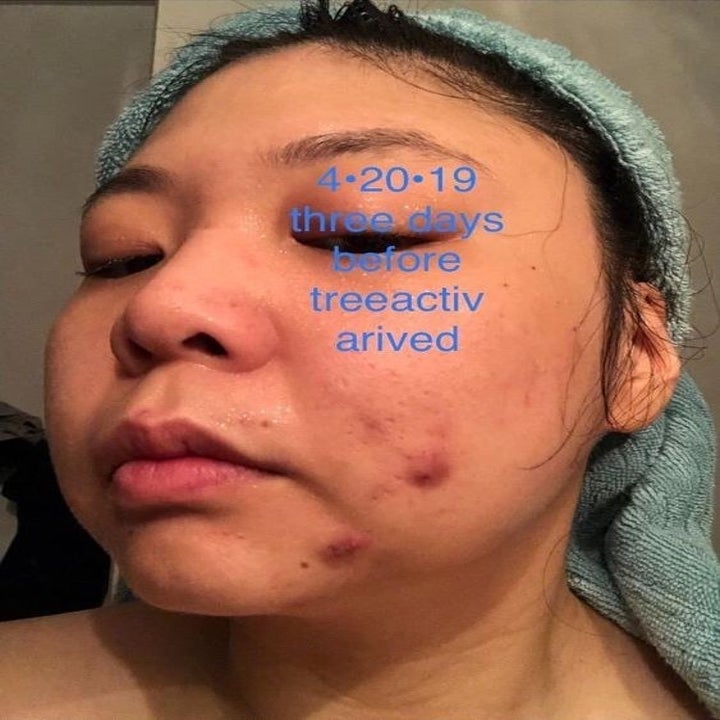 31 Ways To Help Get Rid Of A Pimple In A Hurry