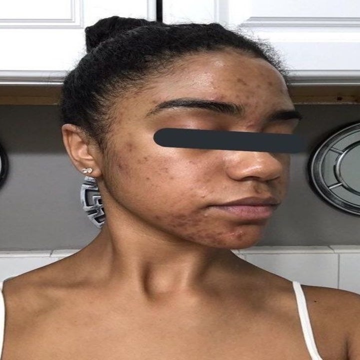 31 Ways To Help Get Rid Of A Pimple In A Hurry