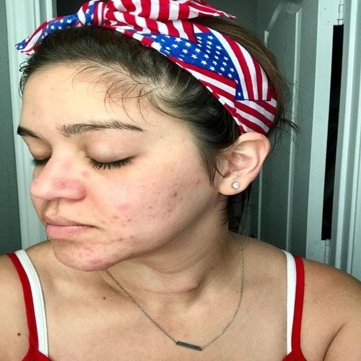 31 Ways To Help Get Rid Of A Pimple In A Hurry