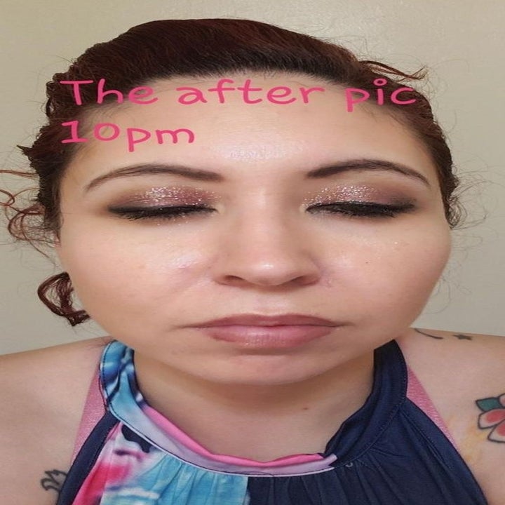 31 Ways To Help Get Rid Of A Pimple In A Hurry