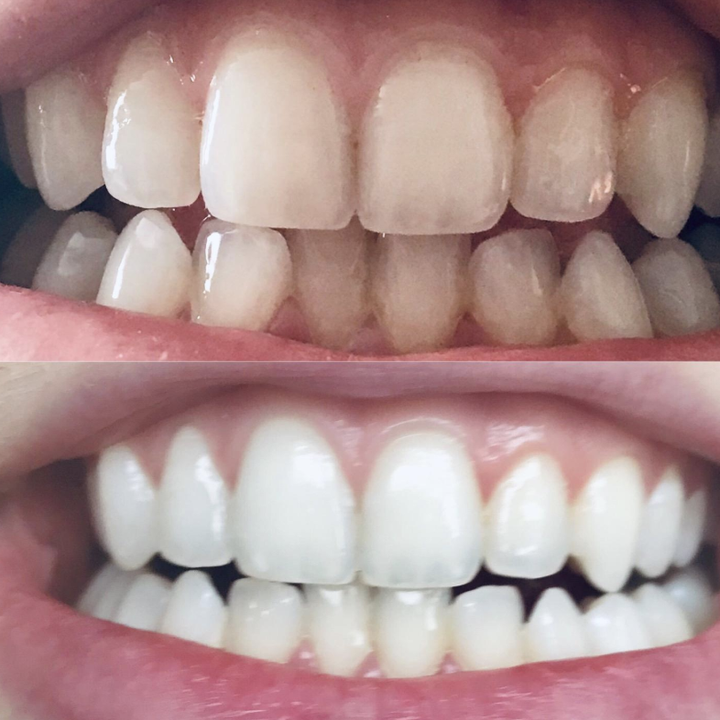 21 Of The Best Teeth Whiteners You Can Get On Amazon