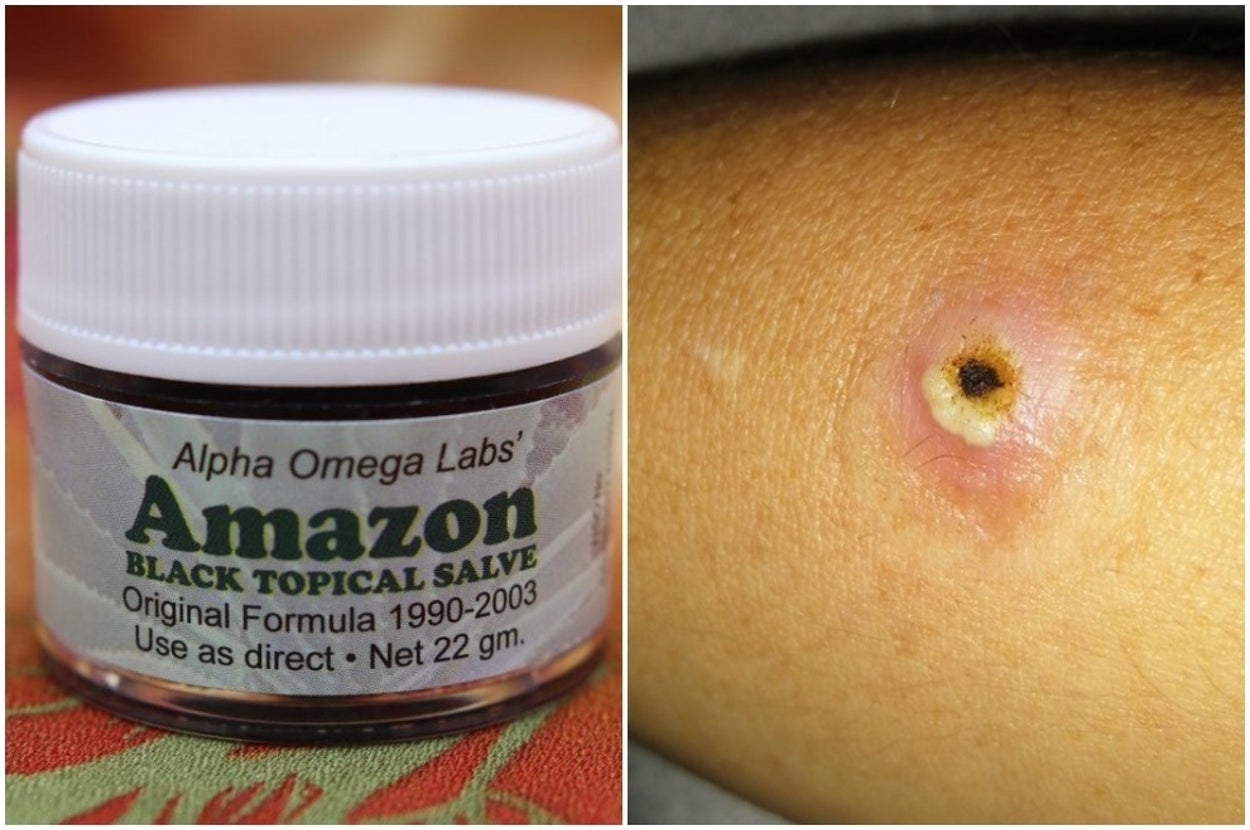 Facebook Has Banned Groups That Promote Flesh-Eating Fake Cancer Cures