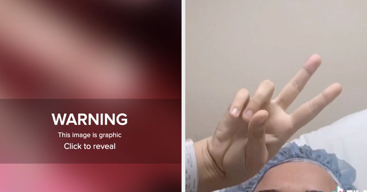 A Girl On Tiktok Almost Had Her Fingertip Amputated Because Of Her Nail