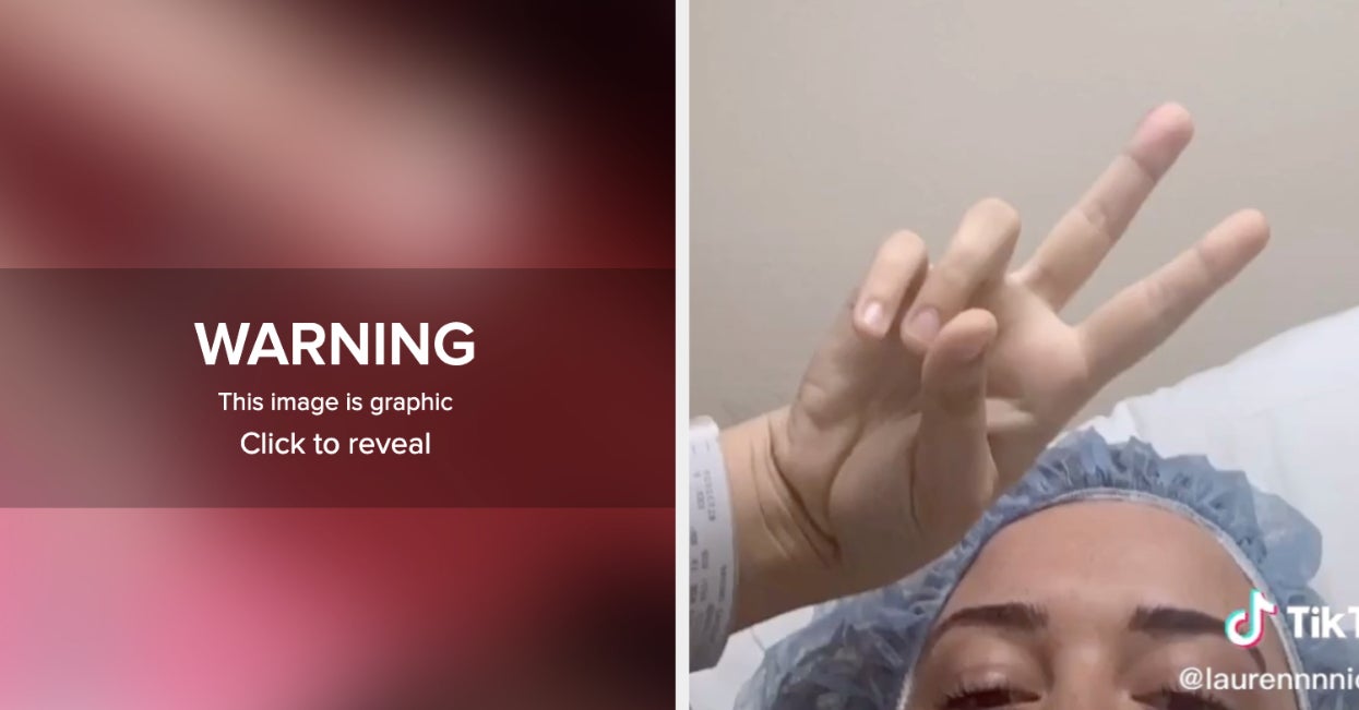 A Girl On Tiktok Almost Had Her Fingertip Amputated Because Of Her Nail
