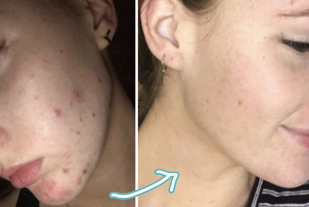 If You Suffer From Acne, You Have To See The Before-And-After Photos ...