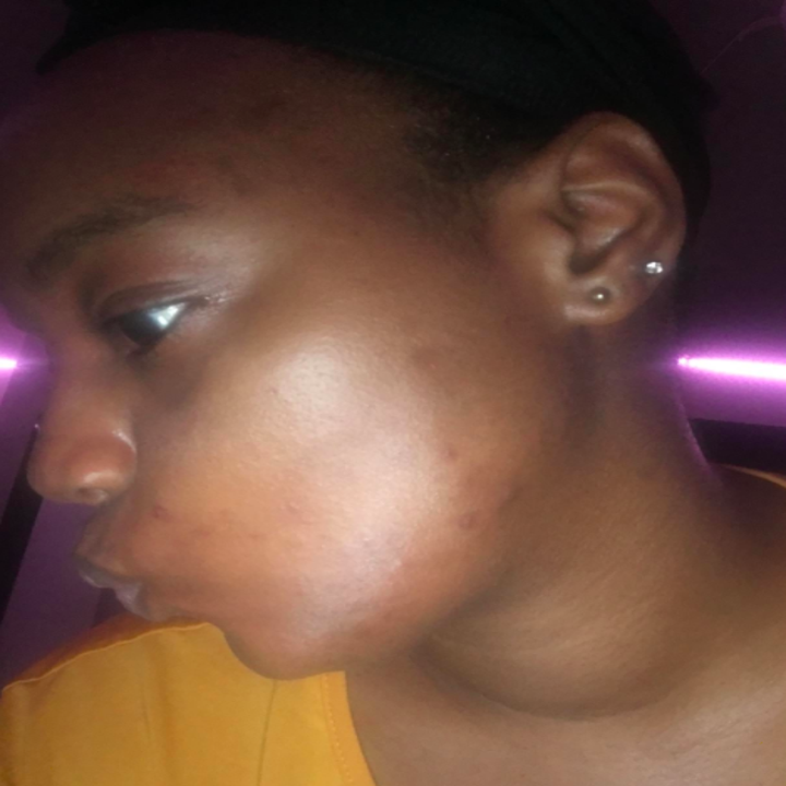 15 Products For Cystic Acne Our Readers Actually Swear By