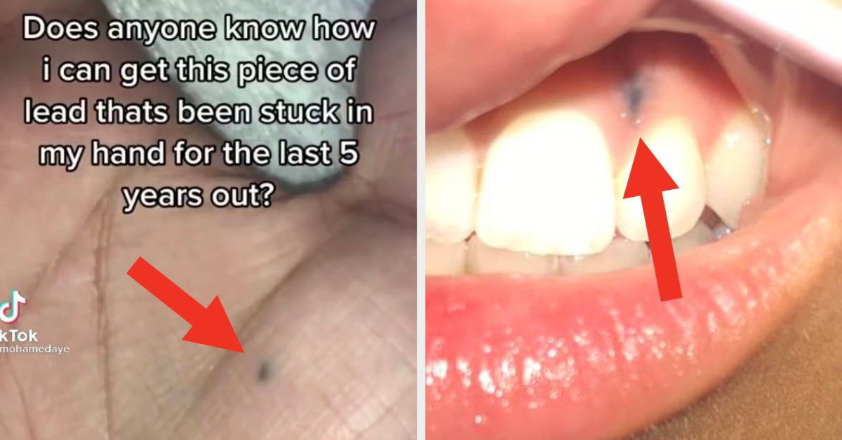 People Are Sharing Their "Lead" Pencil Scars And You Definitely Know ...